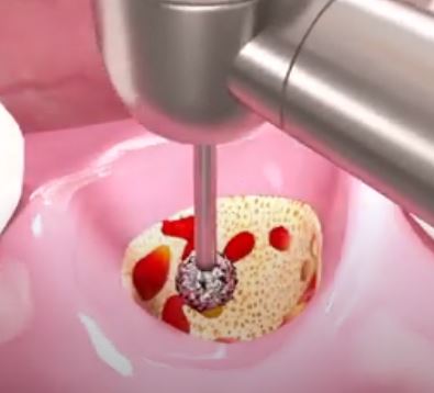 Degranulation, GBR, Bio-Oss, ethoss,