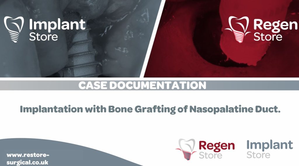 Powerbone Dental Putty membrane free synthetic bone graft