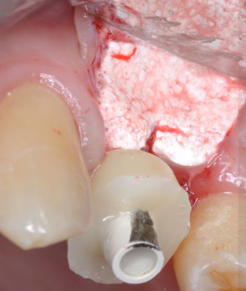 Powerbone Dental Putty membrane free synthetic bone graft