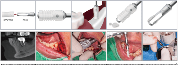 Autogenous Bone Collection Kit (Complete) | Restore Surgical
