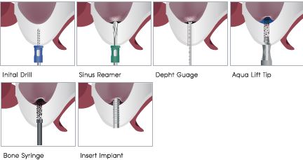 Sinus Kit (Crestal Approach) | Restore Surgical