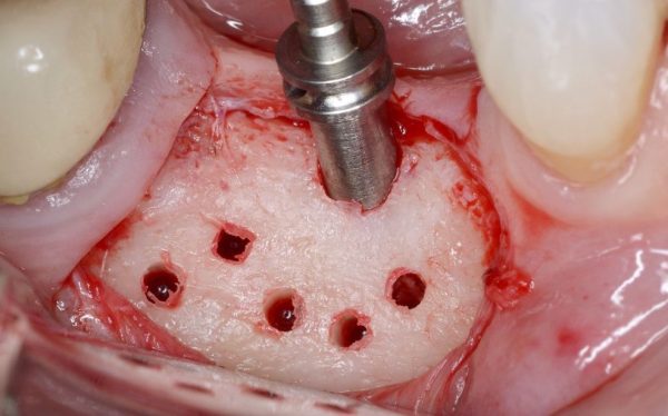 Bone Decortication | Restore Surgical